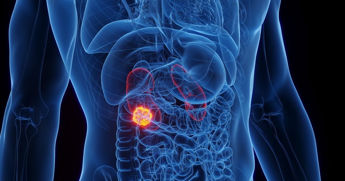 Markers for Papillary Renal Cell Carcinoma | aimed analytics